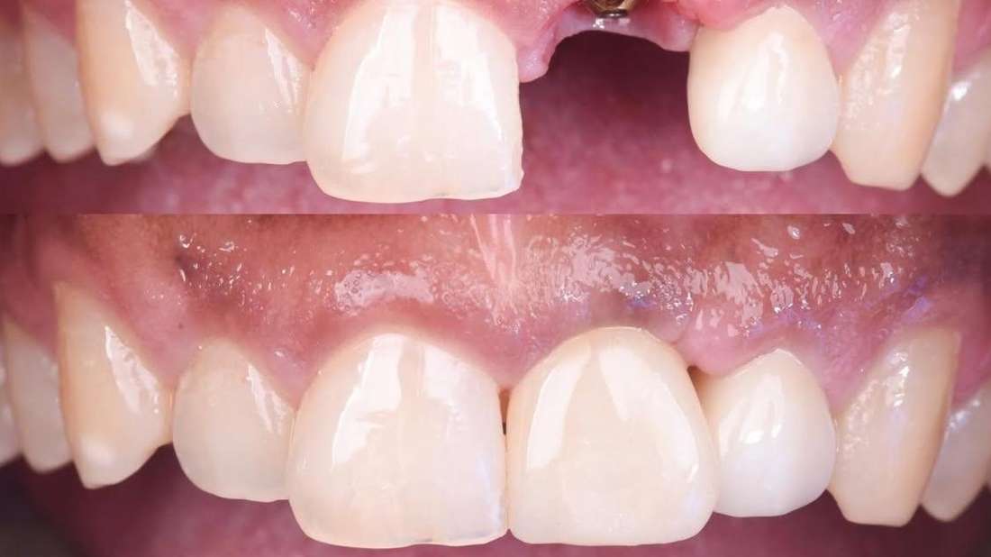 Immediate vs. Delayed Dental Implant Placement: What's Best for You ...